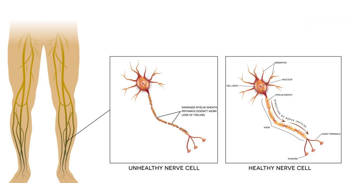 CMT1A Investigative Therapy PXT3003 Focus of Pharnext's Phase 3 Trials